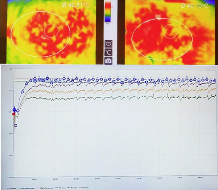 Hyperthermie - mit Wärme gegen Krebs – Lindenhofgruppe AG